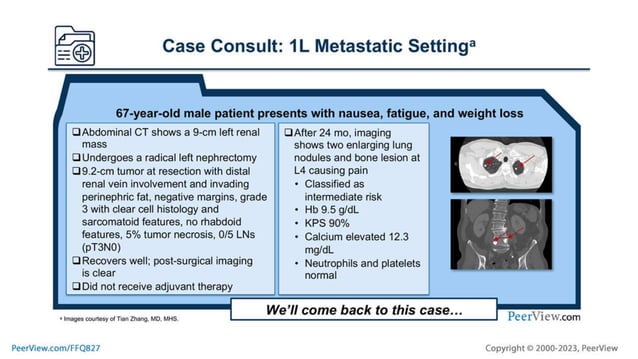 Breaking New Ground in RCC Management: Expert Guidance on Leveraging ...