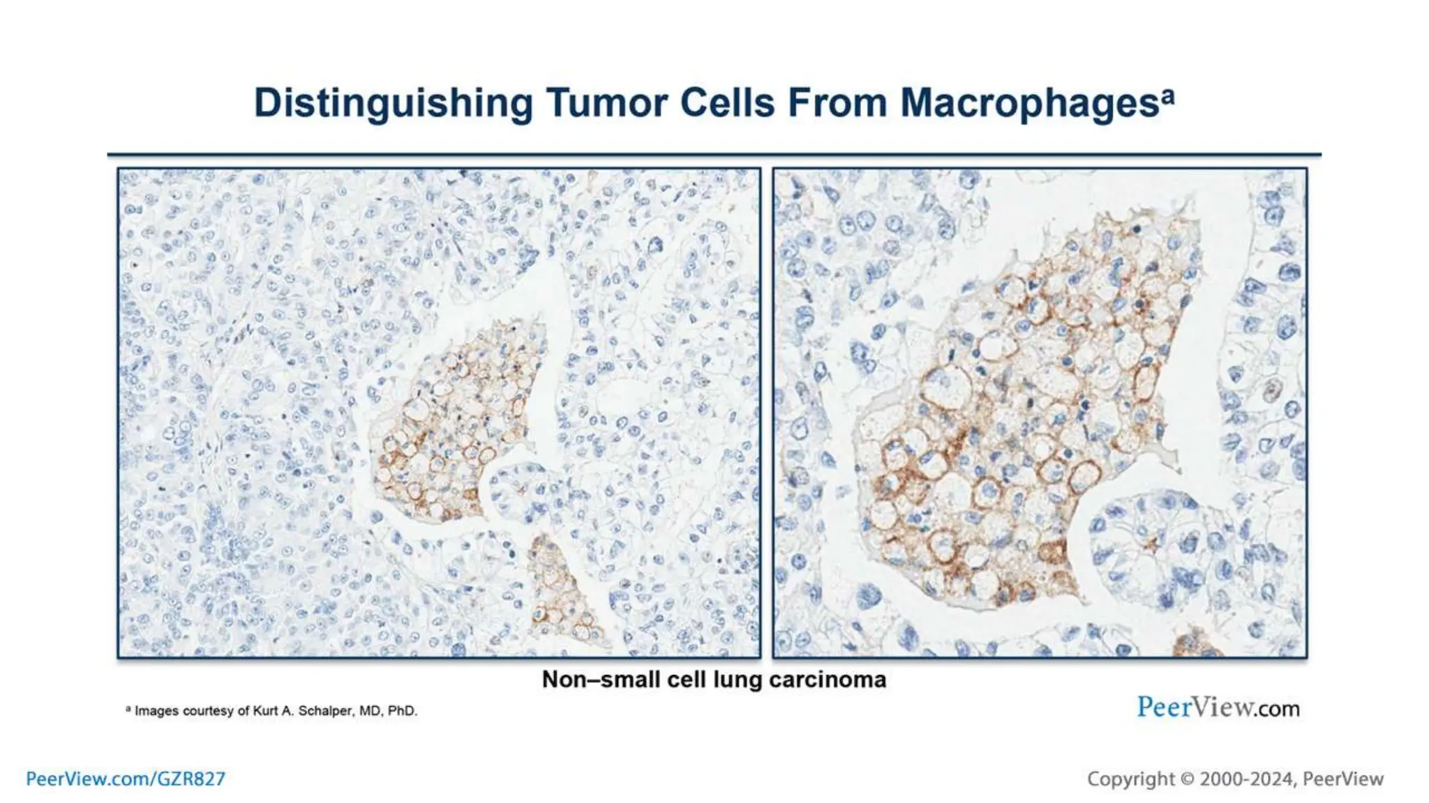 PATHway to Decoding the Impact of Cancer Immunotherapy: Latest Advances ...
