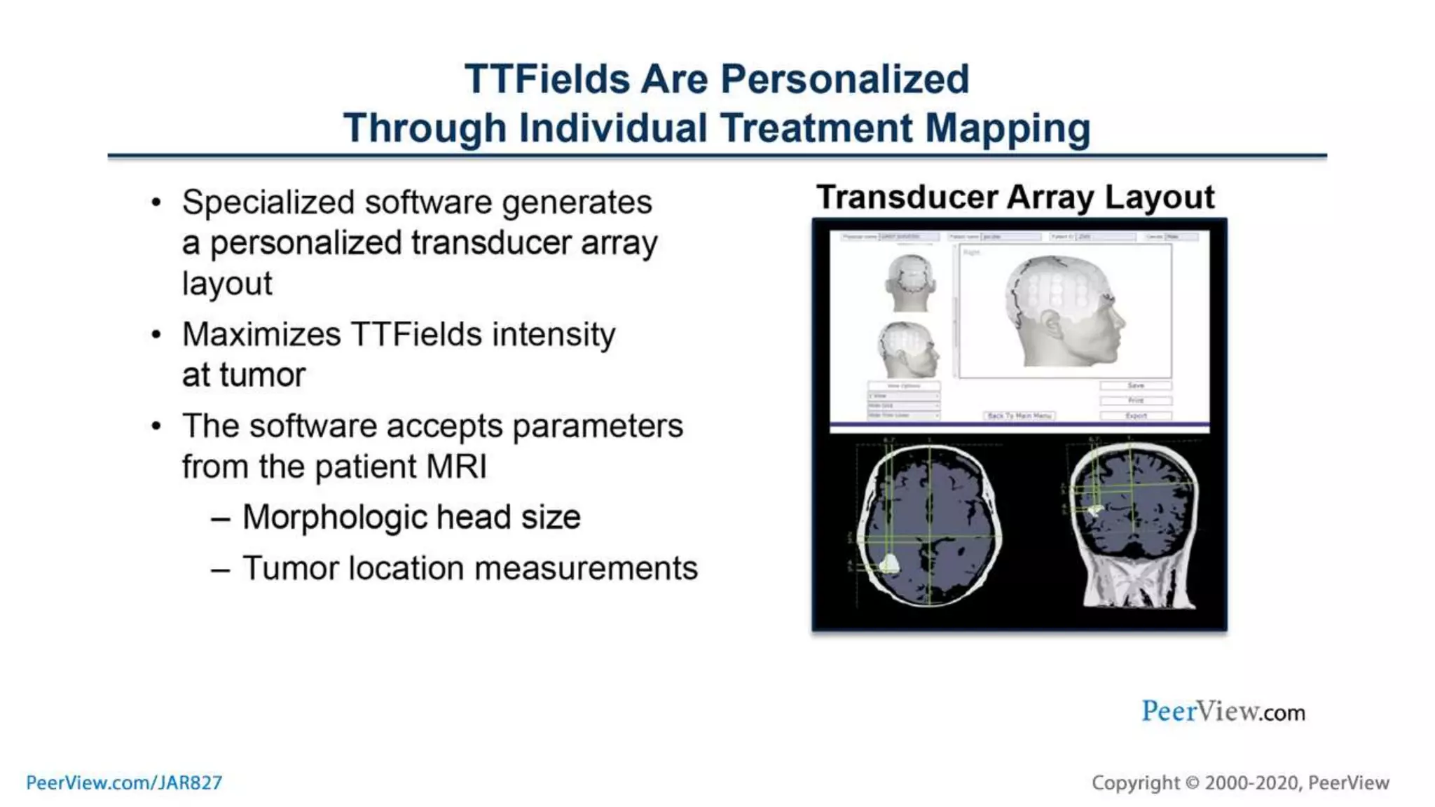 A Clinician Guide to Tumor Treating Fields as a Fourth Modality in ...