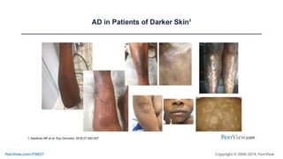 Advances in the Management of Moderate to Severe Atopic Dermatitis: How ...