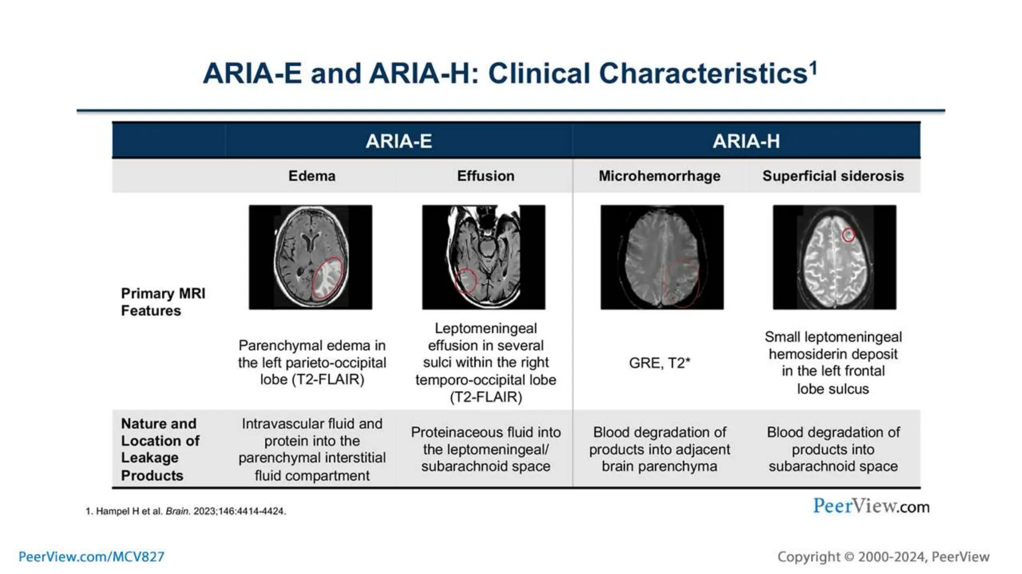 Improving the Recognition and Management of Amyloid-Related Imaging ...