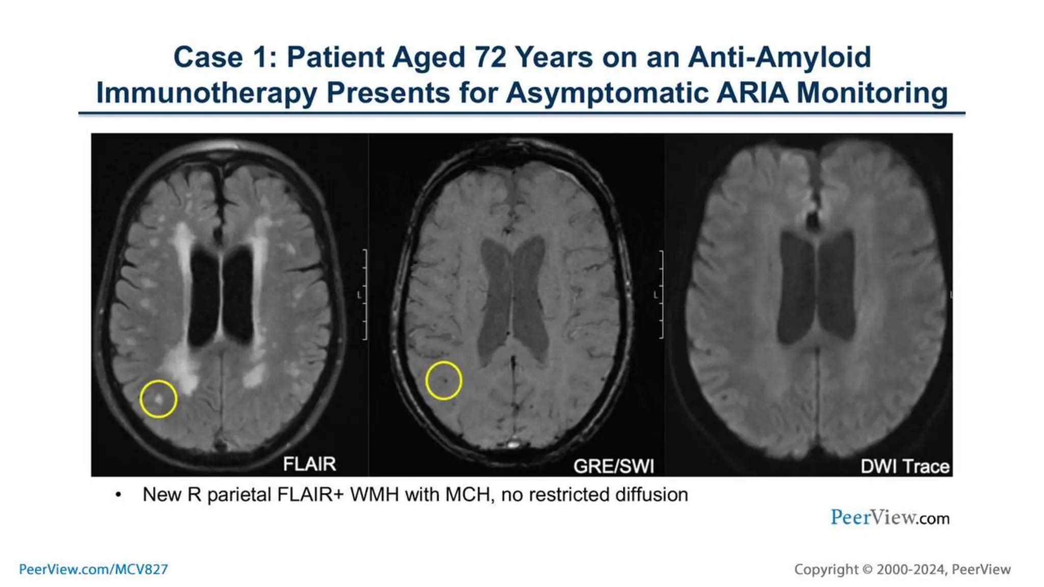 Improving the Recognition and Management of Amyloid-Related Imaging Abnormalities (ARIA) in ...