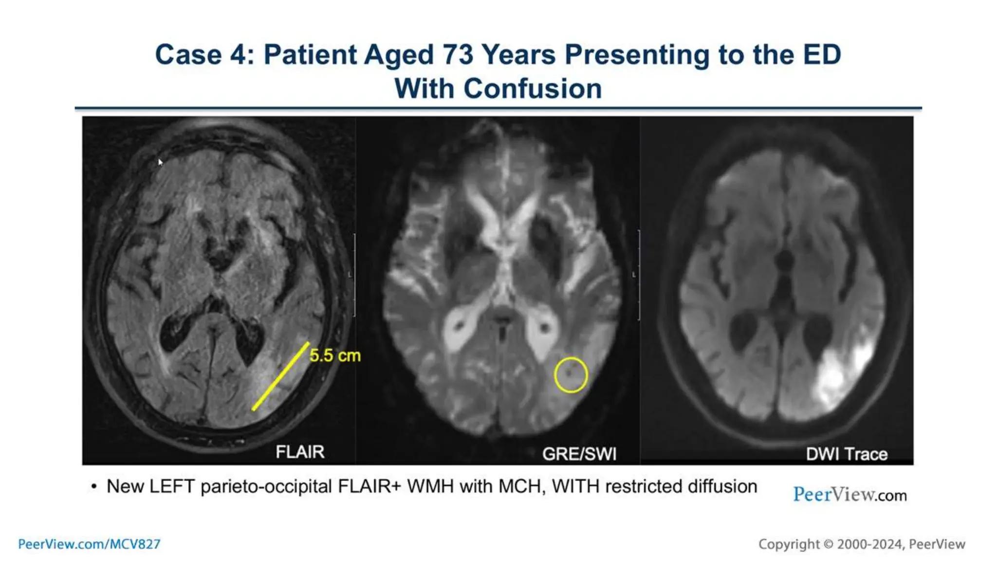 Improving the Recognition and Management of Amyloid-Related Imaging ...