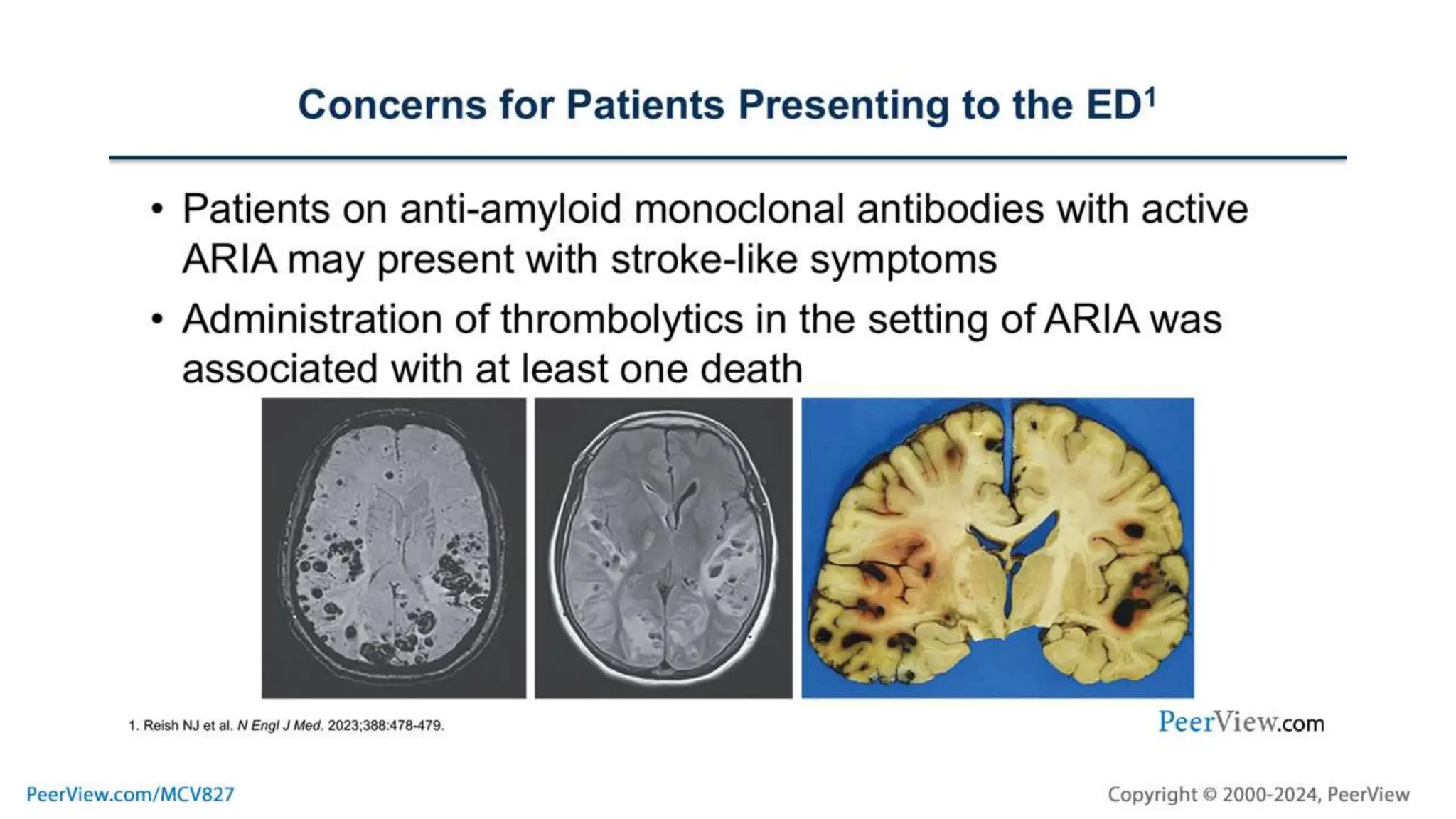 Improving the Recognition and Management of Amyloid-Related Imaging ...