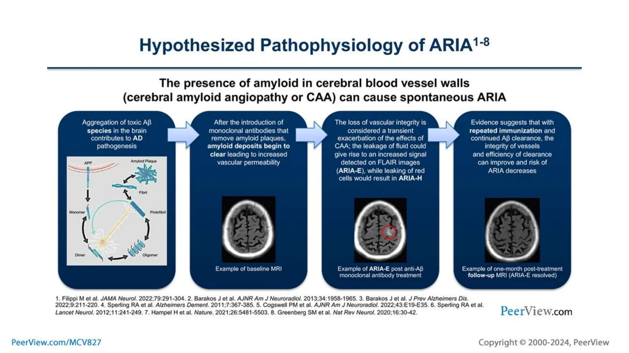 Improving the Recognition and Management of Amyloid-Related Imaging ...