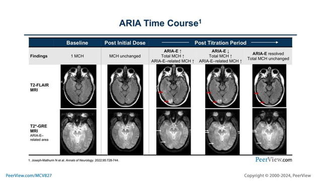 Improving the Recognition and Management of Amyloid-Related Imaging ...