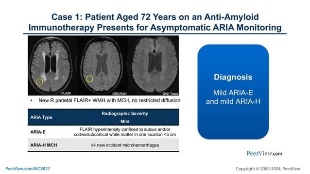 Improving the Recognition and Management of Amyloid-Related Imaging ...