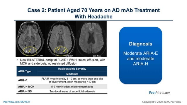 Improving the Recognition and Management of Amyloid-Related Imaging ...