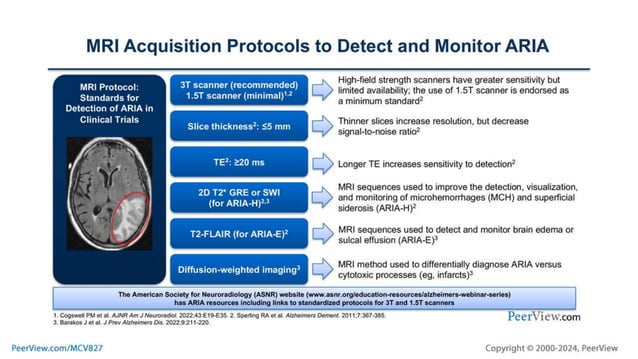 Improving the Recognition and Management of Amyloid-Related Imaging ...