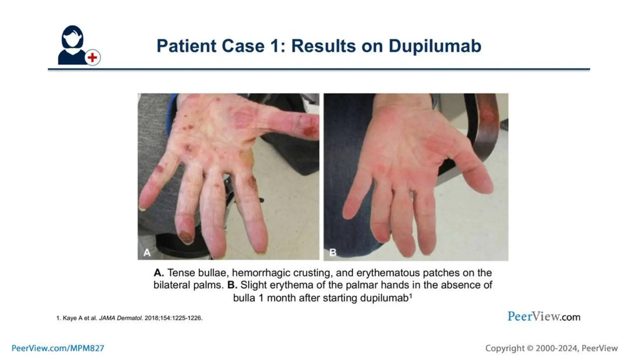Addressing Unmet Patient Needs in Bullous Pemphigoid: Exploring ...