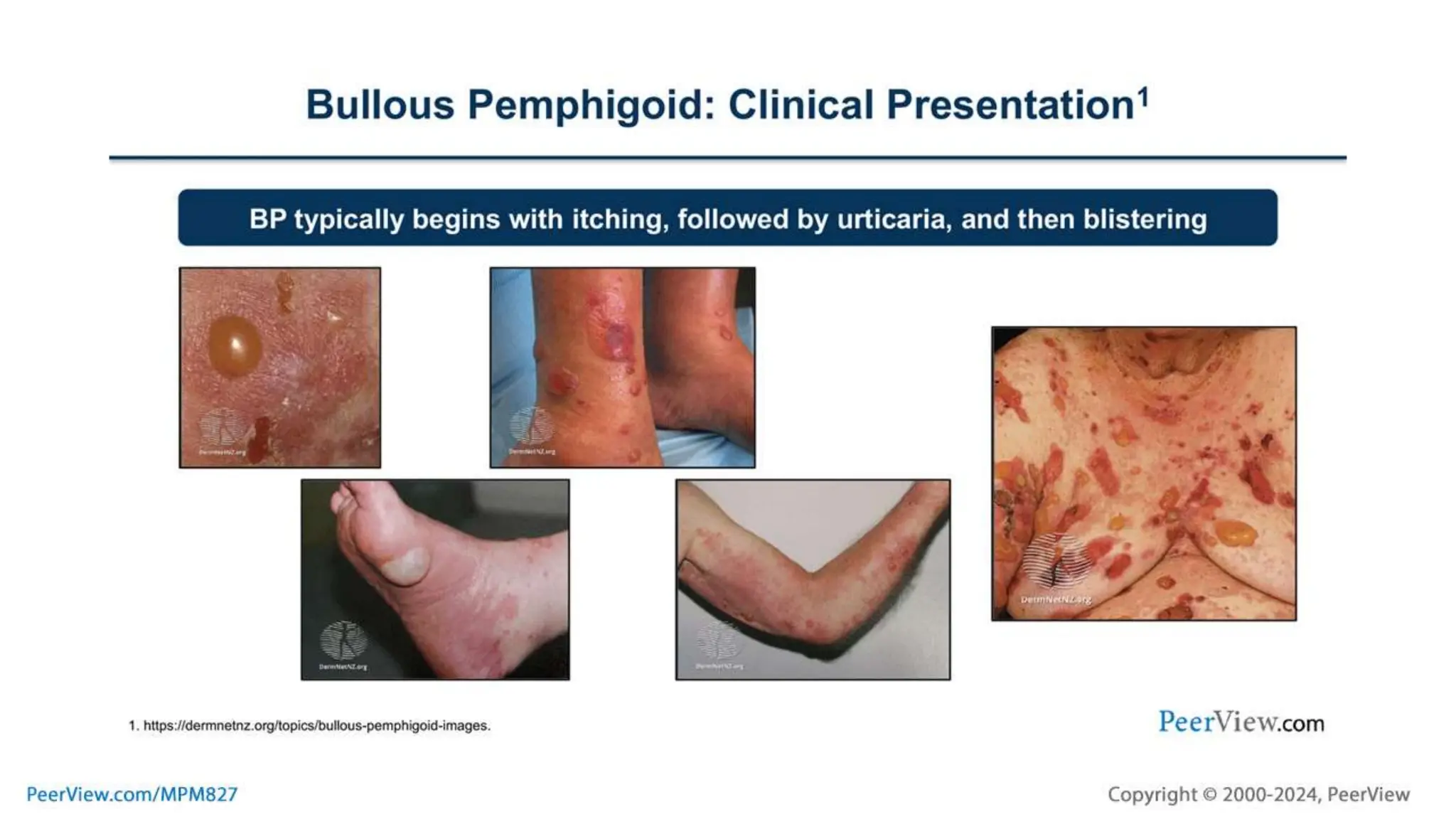Addressing Unmet Patient Needs in Bullous Pemphigoid: Exploring ...