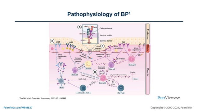 Addressing Unmet Patient Needs in Bullous Pemphigoid: Exploring ...