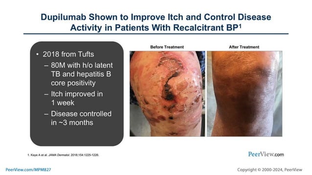 Addressing Unmet Patient Needs in Bullous Pemphigoid: Exploring ...