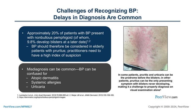 Addressing Unmet Patient Needs in Bullous Pemphigoid: Exploring ...