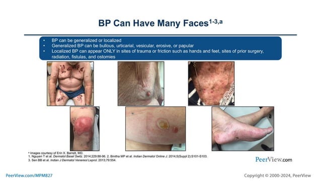 Addressing Unmet Patient Needs in Bullous Pemphigoid: Exploring ...