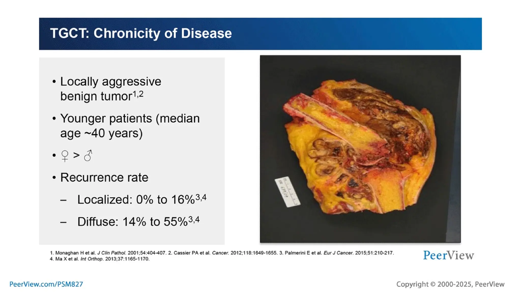Achieving Disease Control in TGCT: Critical Steps For Integrating ...