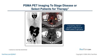 On Target: Understanding the Impact of PSMA for Diagnostic and ...