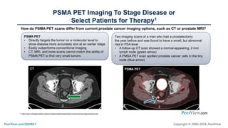 On Target: Understanding the Impact of PSMA for Diagnostic and ...