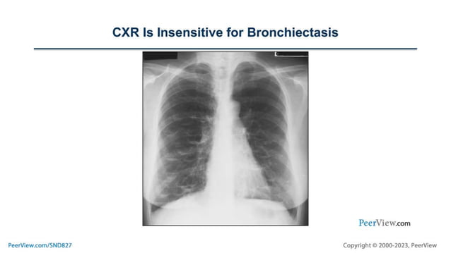 Taking a Look Ahead in Non–Cystic Fibrosis Bronchiectasis: Leveraging ...