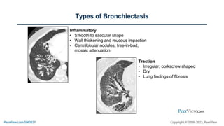 Taking a Look Ahead in Non–Cystic Fibrosis Bronchiectasis: Leveraging ...