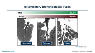 Taking a Look Ahead in Non–Cystic Fibrosis Bronchiectasis: Leveraging ...