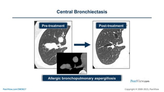 Taking a Look Ahead in Non–Cystic Fibrosis Bronchiectasis: Leveraging ...