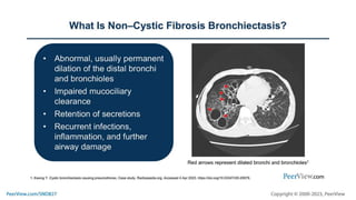 Taking a Look Ahead in Non–Cystic Fibrosis Bronchiectasis: Leveraging ...