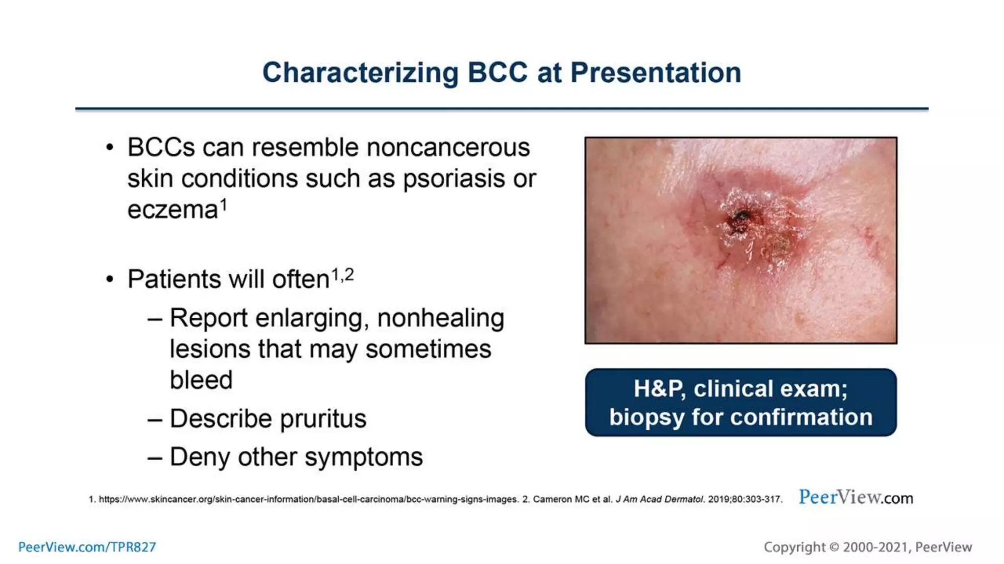 Innovative Immunotherapy in Advanced Basal Cell Carcinoma: Evolving ...