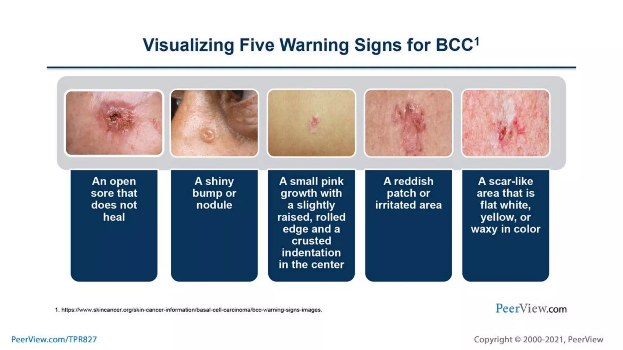 Innovative Immunotherapy in Advanced Basal Cell Carcinoma: Evolving ...