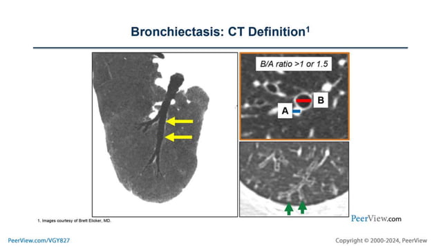 Bridging the Gap to Improved Outcomes in Non-Cystic Fibrosis ...