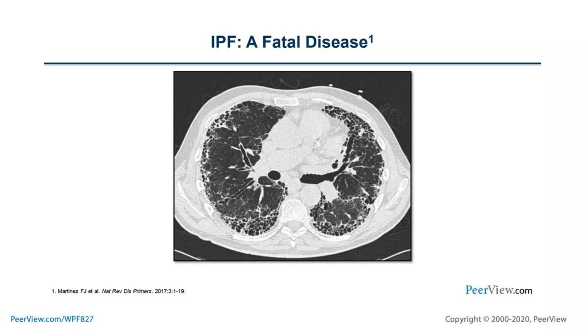 Differential Diagnosis of Interstitial Lung Diseases: Interpreting HRCT ...