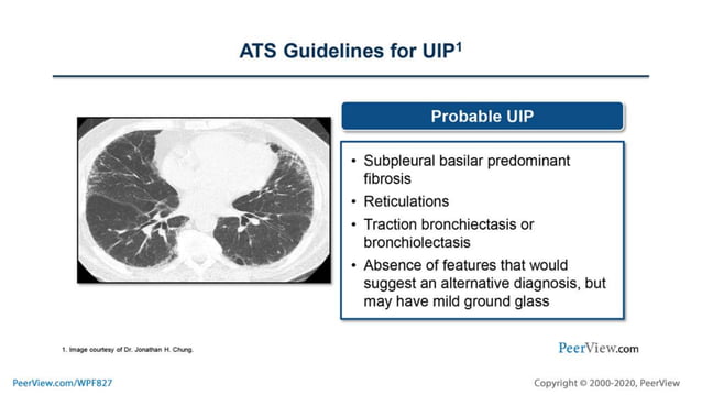 Differential Diagnosis of Interstitial Lung Diseases: Interpreting HRCT ...