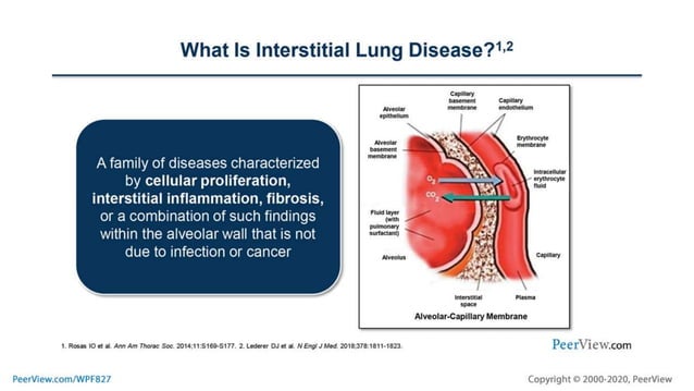 Differential Diagnosis of Interstitial Lung Diseases: Interpreting HRCT ...