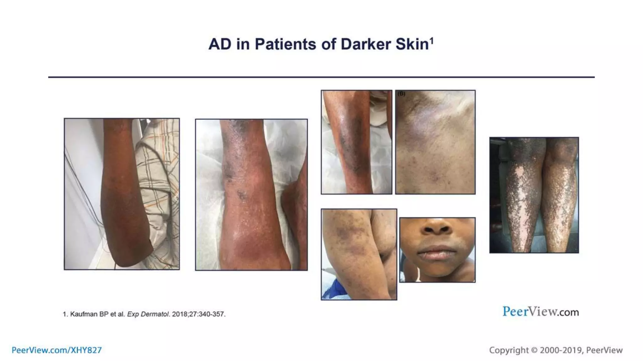 A Closer Look at the Atopic Dermatitis Patient Journey: Effective ...