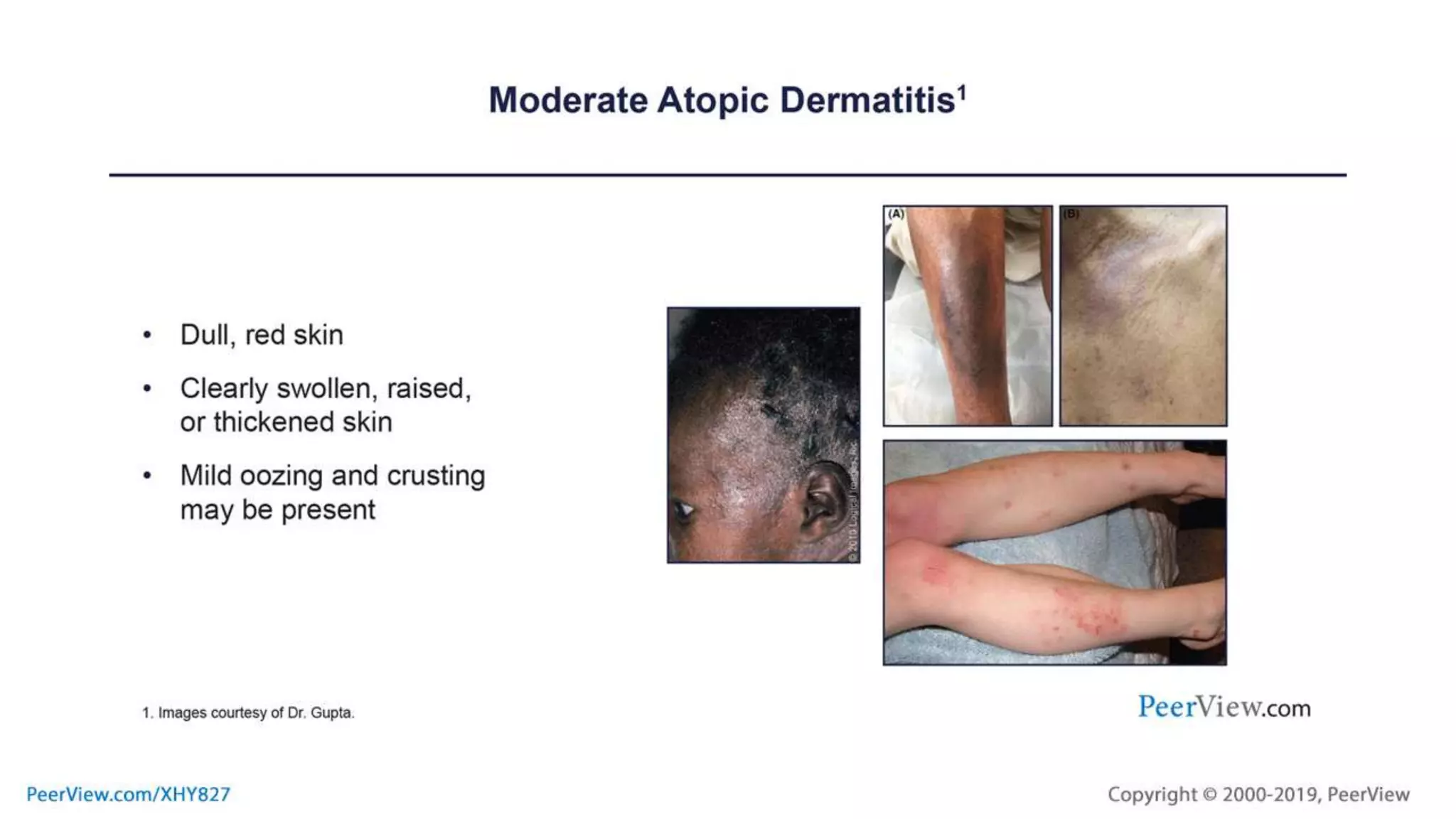 A Closer Look at the Atopic Dermatitis Patient Journey: Effective ...
