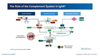 Advancements in IgA Nephropathy: Discovering the Potential of ...