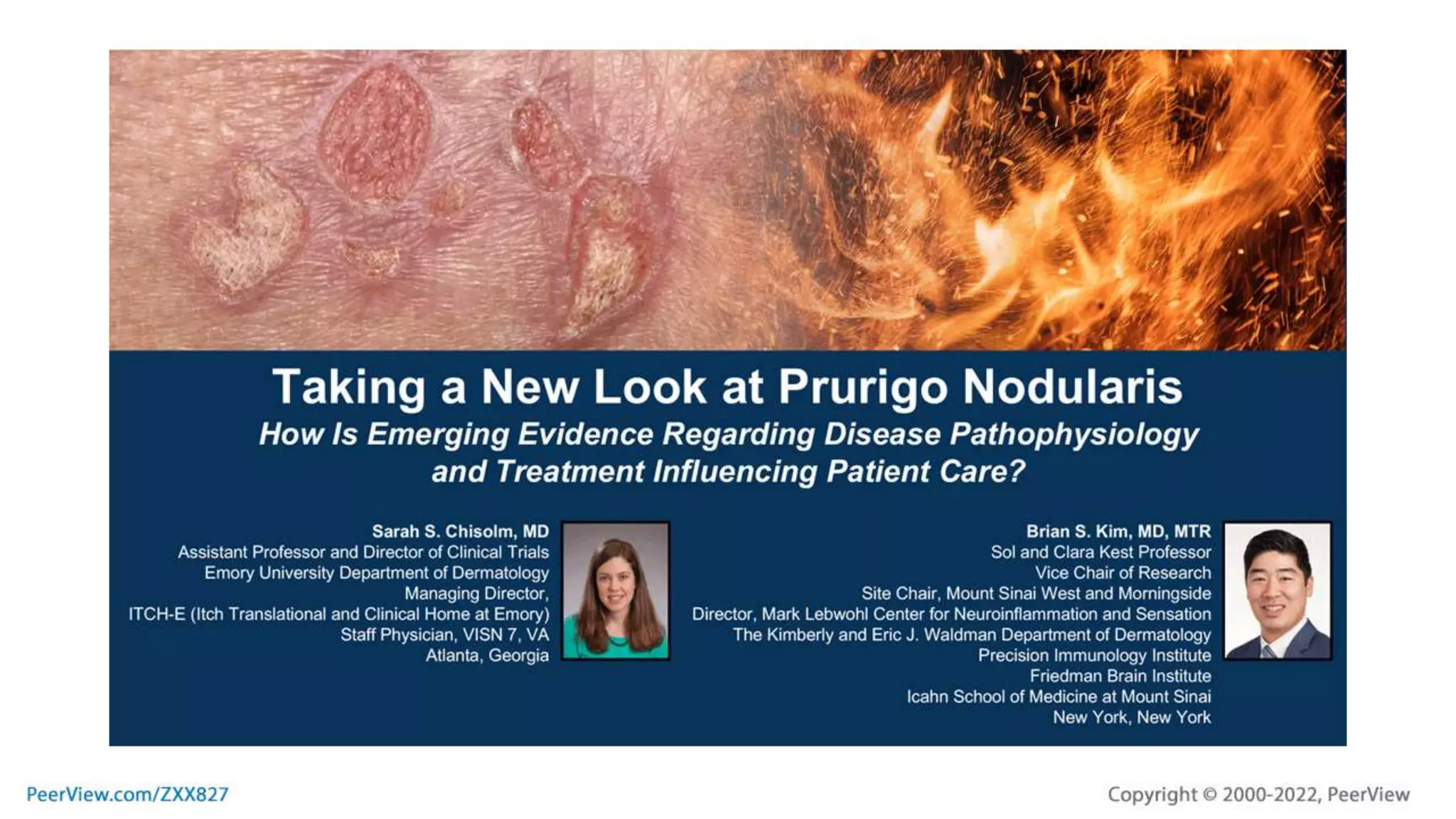 Taking a New Look at Prurigo Nodularis: How Is Emerging Evidence ...