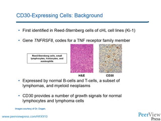 Expert Thoughts on Managing CD30-Expressing Lymphoma: From Disease ...