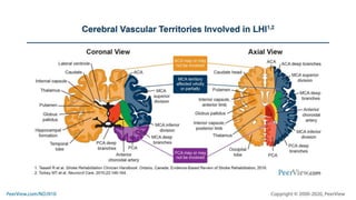 Large Hemispheric Infarction: Exploring the Latest Clinical Advances in ...