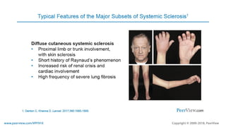 Systemic Sclerosis-Associated Interstitial Lung Disease (SSc-ILD ...