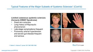 Systemic Sclerosis-Associated Interstitial Lung Disease (SSc-ILD): Expert Insights on Current ...