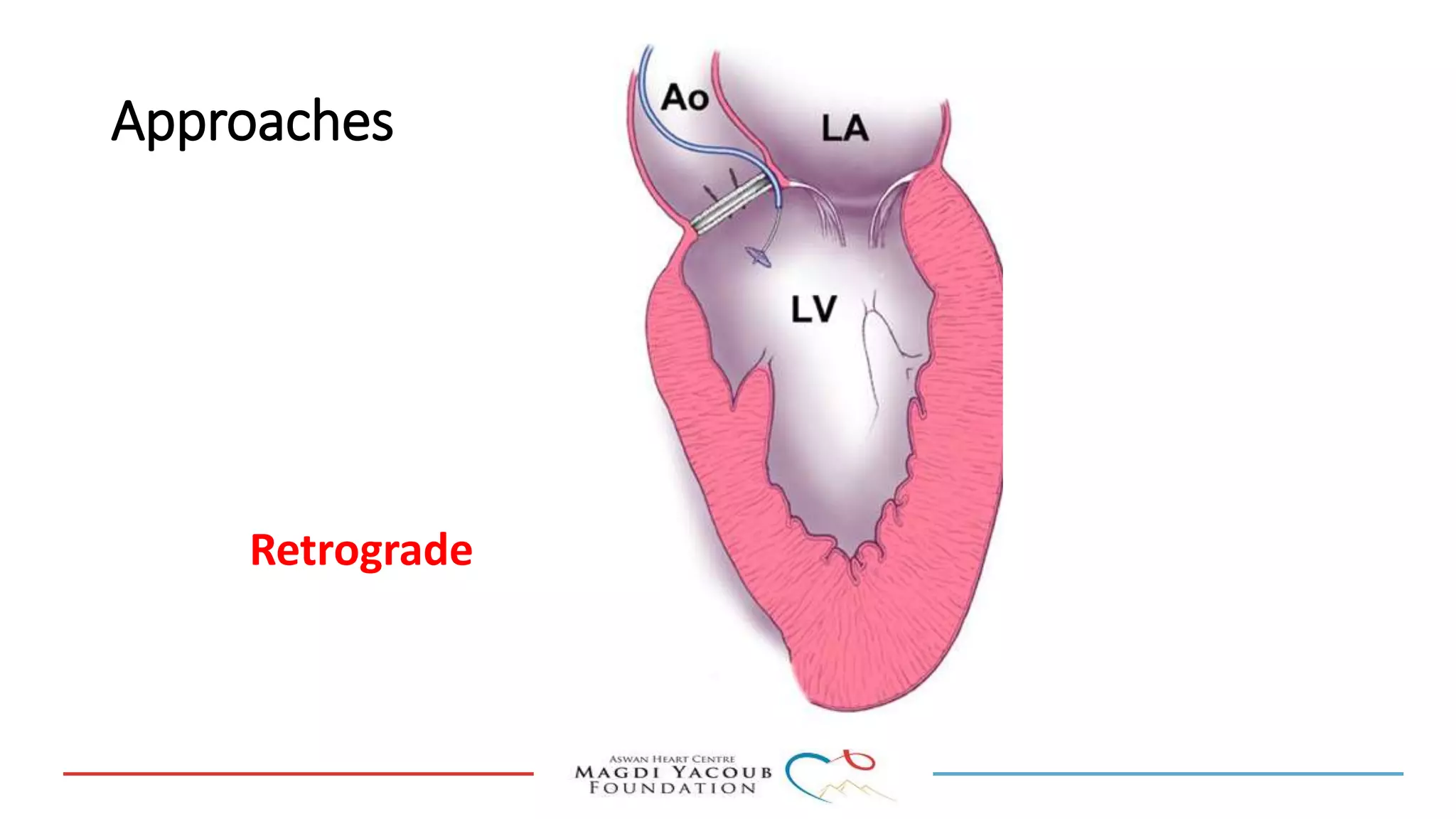 Percutanous PVL closure | PPT