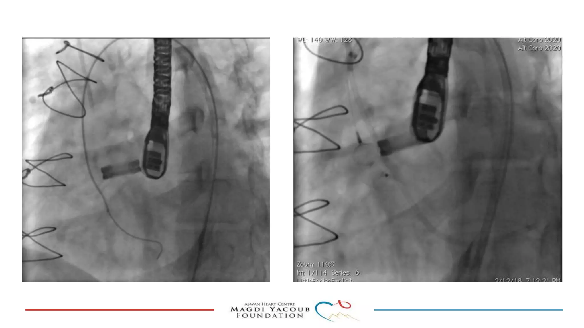 Percutanous PVL closure | PPT