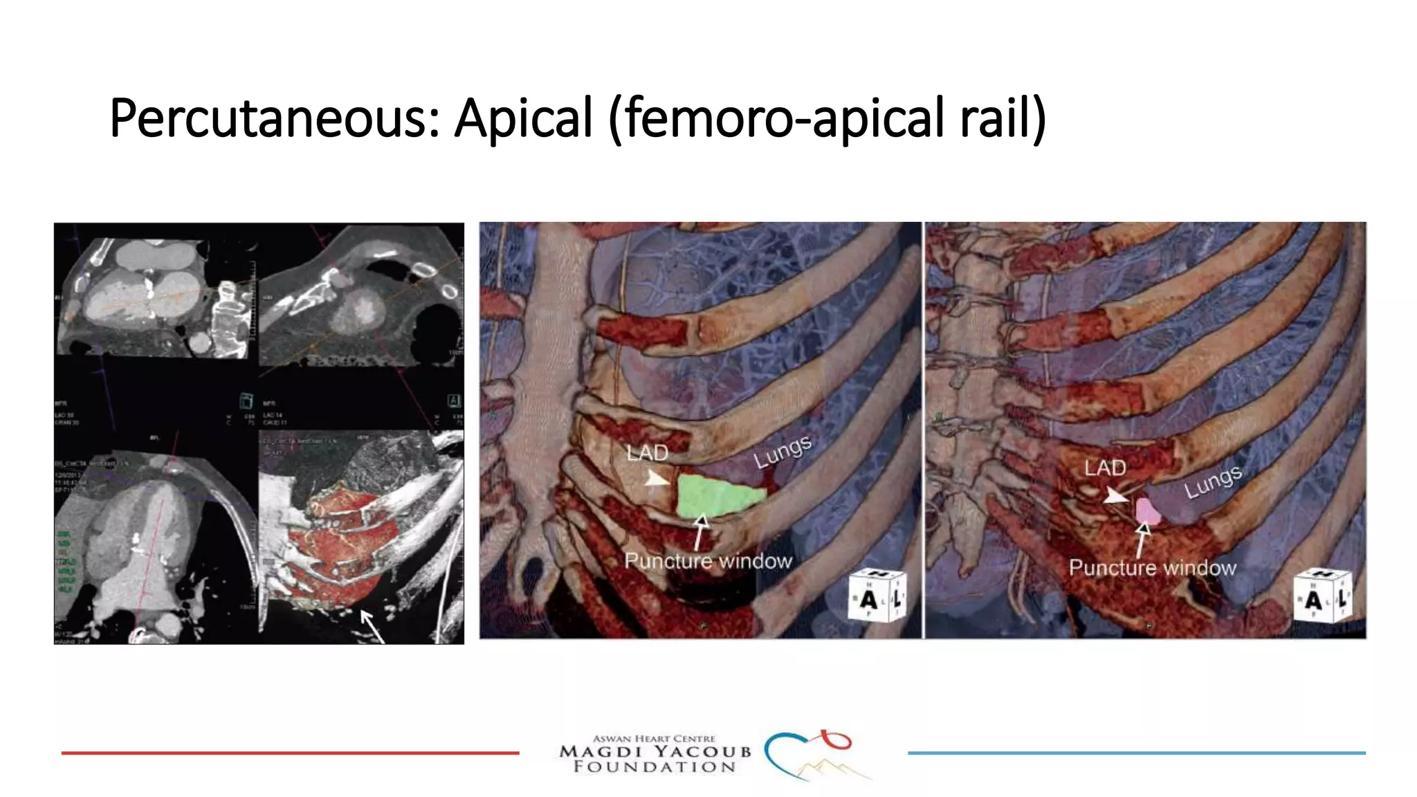 Percutanous PVL closure | PPT