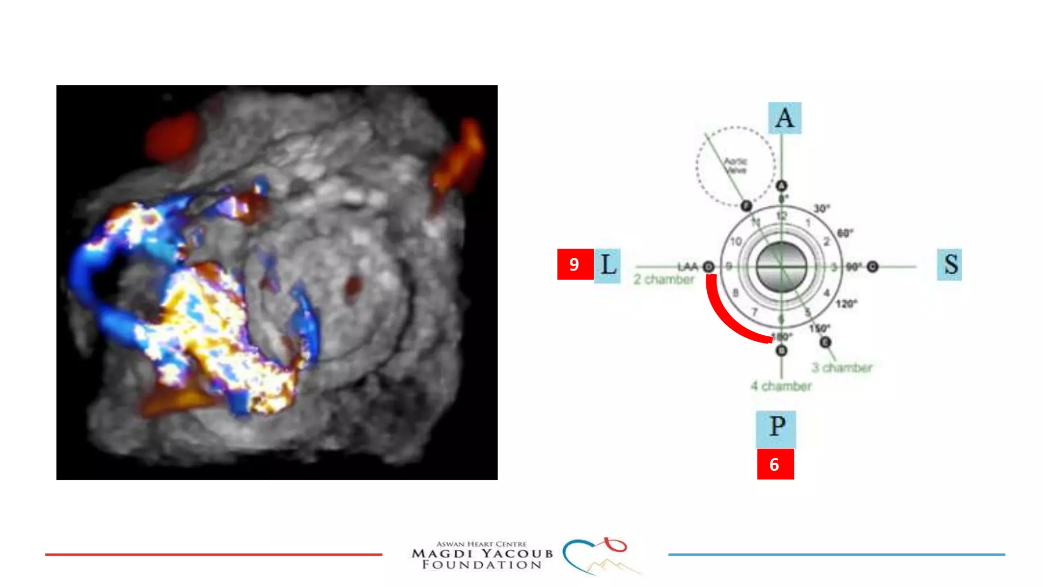 Percutanous PVL closure | PPT