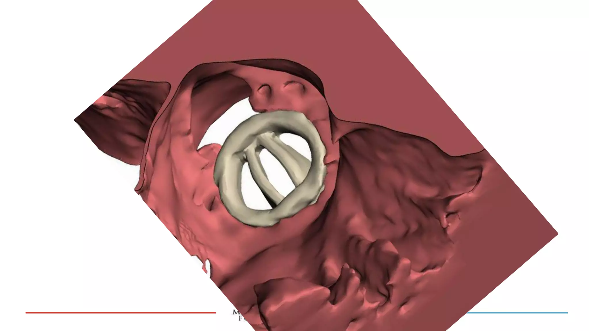 Percutanous PVL closure | PPT