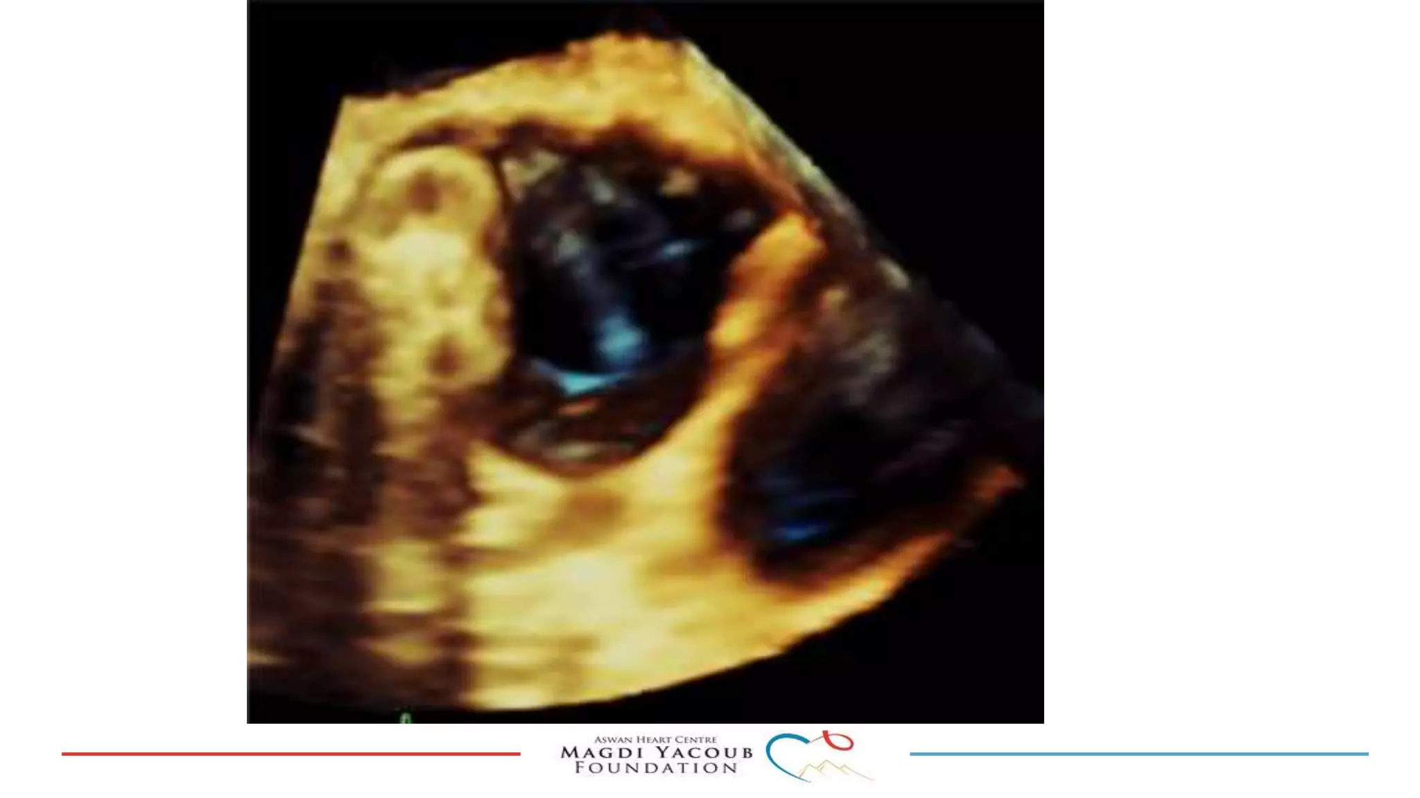 Percutanous PVL closure | PPT