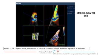 Percutanous PVL closure | PPT
