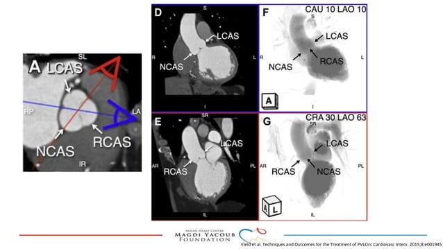 Percutanous PVL closure | PPT