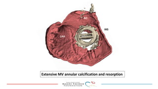 Percutanous PVL closure | PPT